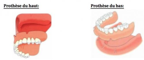 La prothèse adjointe complète - Cabinet Dentaire